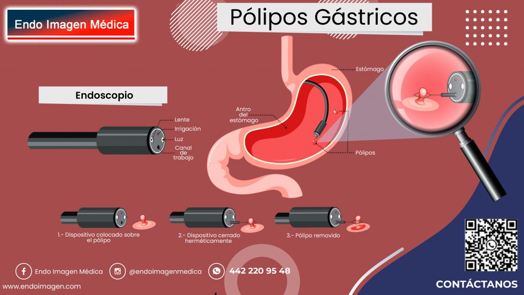 Pólipos Gástricos. – Endo Imagen Médica